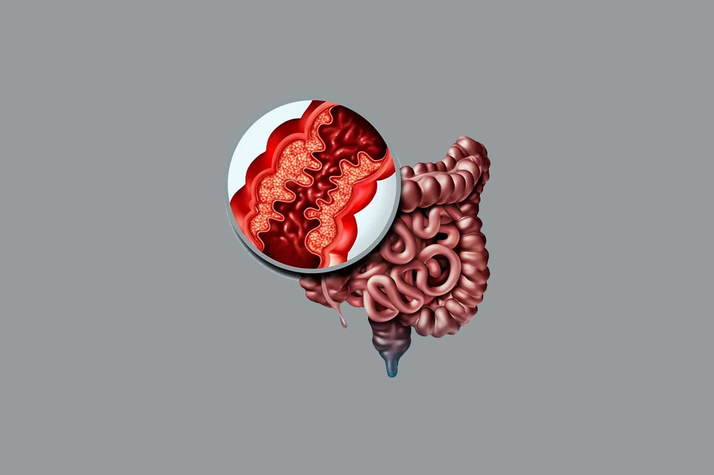 Doença de Crohn: informações gerais, sintomas, diagnóstico e ...